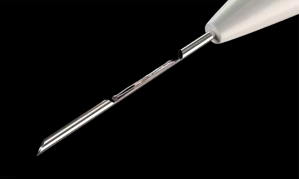 6 حقائق هامة عن تقنية FUE Smart Implanters - Sherif Hegazy